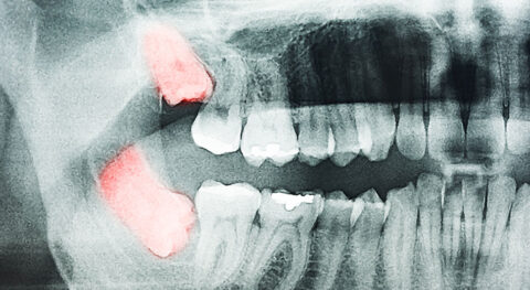Understanding the Benefits of Wisdom Teeth Removal - Roberson Dental